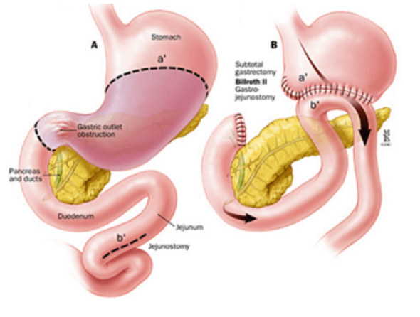 Gastro Jejunostomy Elce Clinics