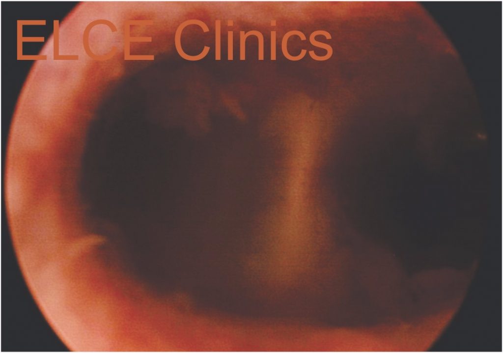 Hysteroscopic Resection of Septum - Elce Clinics