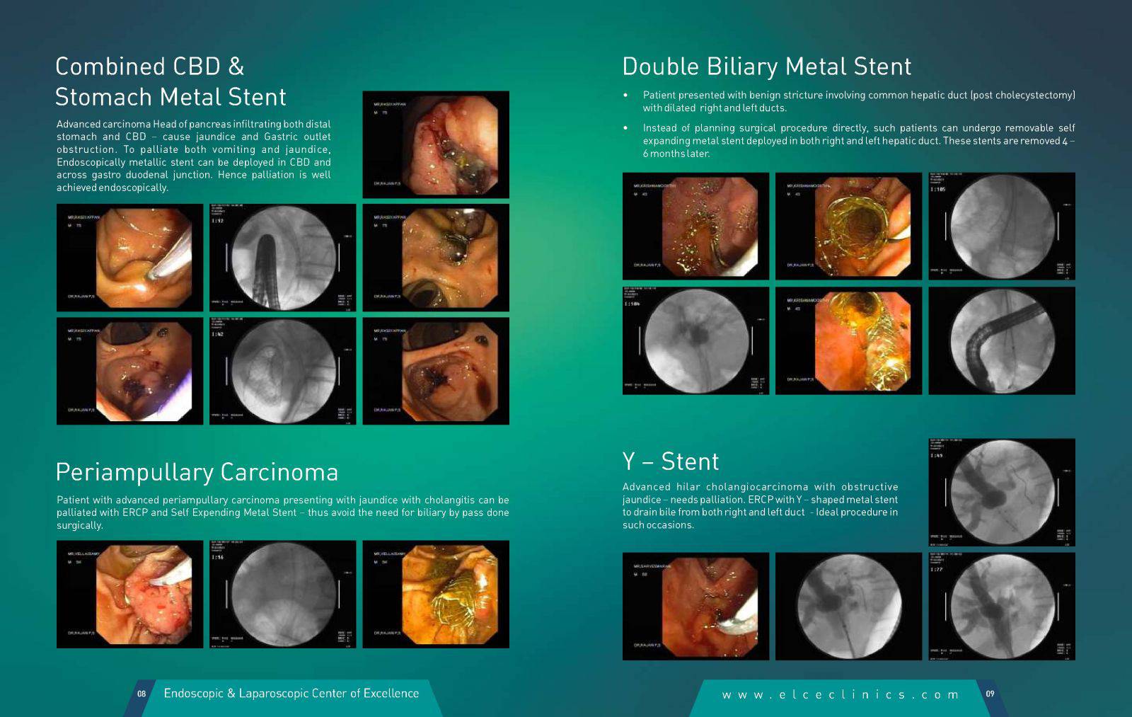 Therapeutic Endoscopy - Elce Clinics