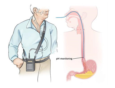 GERD Treatment | Best Treatment to Cure GERD Permanently | ELCE