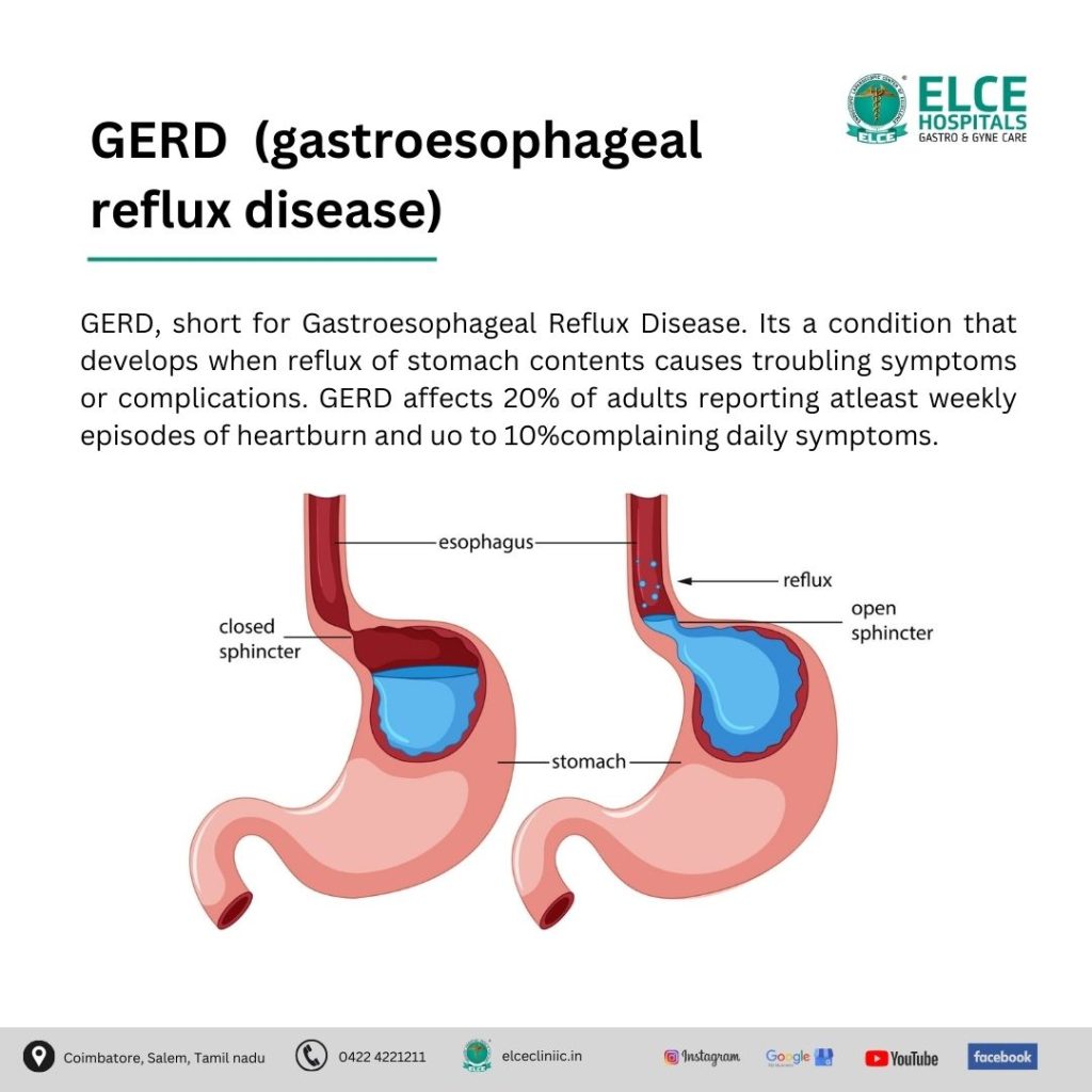 GERD Treatment | GERD Treatment In Coimbatore - Elce Clinic