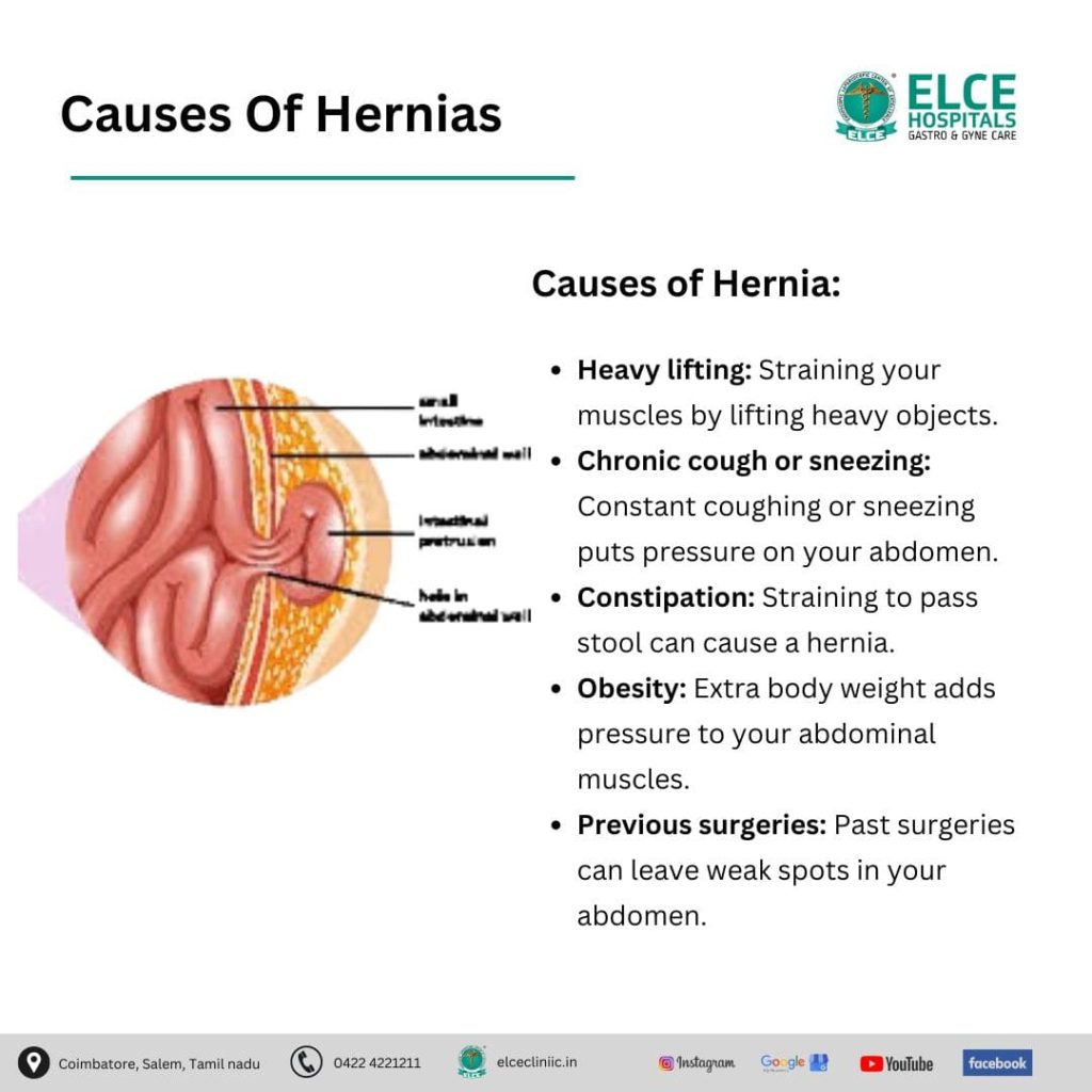 Can Stress Cause A Hernia - EMSEKFLOL.COM